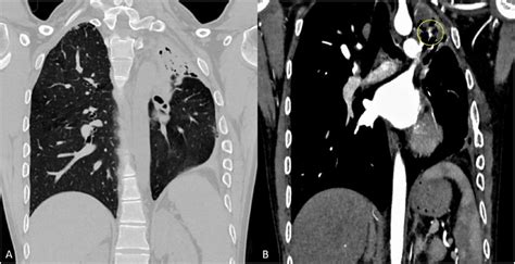 Case 3 Ct Coronal A Soft Tissue Window Showing Cavitary Lung Lesion