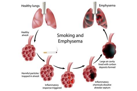 Diseases Caused By Smoking Smoking Cigarettes Adverse Smokers Sutured