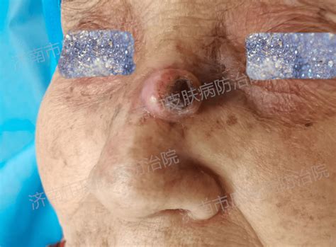 知名专家 容易被忽视的皮肤癌前病变——日光性角化病治疗患者诊断