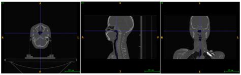 Deep Reinforcement Learning Method For 3D CT Nasopharyngeal Cancer