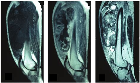 A Sagittal T1 Weighted Mri Showing A Large Irregularly Lobulated