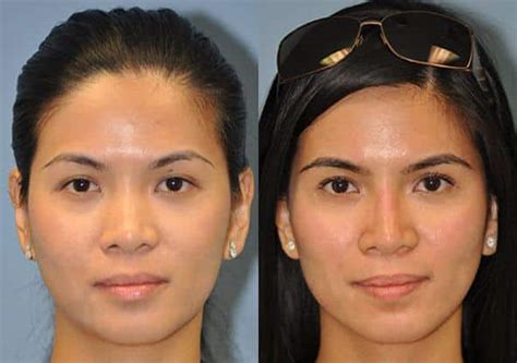Liquidnon Surgical Rhinoplasty In Virginia And Maryland