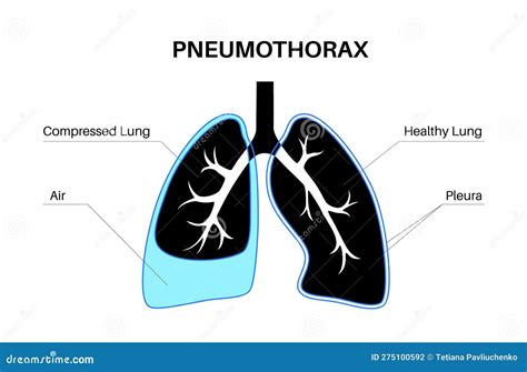 Pneumothorax Anatomical Poster Stock Vector Illustration Of Leak Wall 275100592