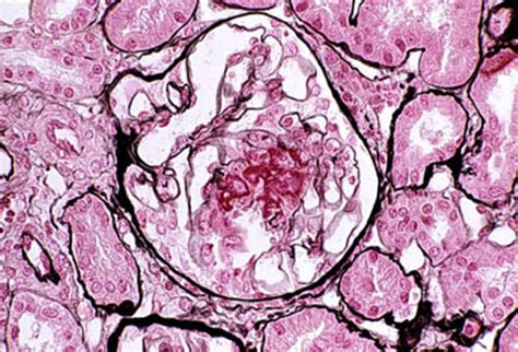 Persistent Productive Cough And Fever Case Presentation