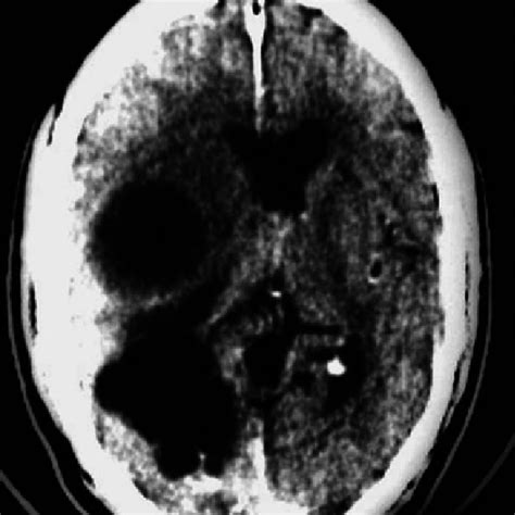 4 Ce4 Type Of Hydatid Cyst Axial T2 Weighted Mri Shows A Large Cyst