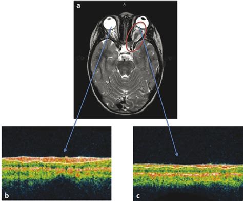 Optic Pathway Gliomas Neupsy Key