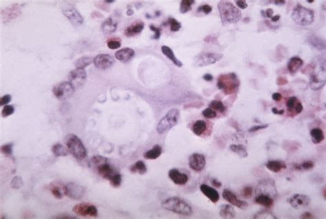 Public Domain Picture Histopathology Of Paracoccidioidomycosis Skin