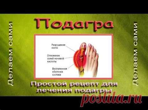 Избавиться от мочевой кислоты, болей в суставах, подагры и артрита, мо ...