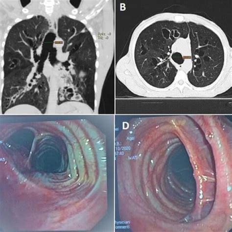 Pre And Post Bronchodilator Spirometry Findings Download Scientific Diagram