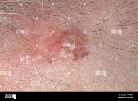 Not To Be Used For Advertising Or In A Defamatory Context Basal Cell