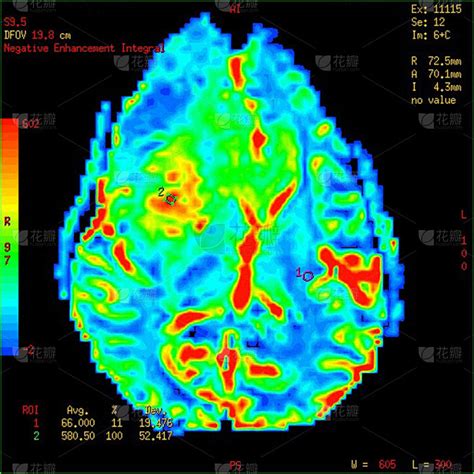 恶性脑肿瘤的mri灌注成像