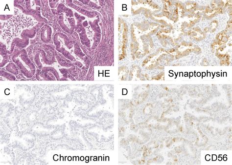Role Of Synaptophysin Chromogranin And Cd56 In Adenocarcinoma And
