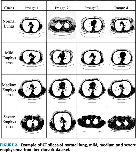 Figure 2 From Adaptive Local Ternary Pattern On Parameter Optimized Faster Region Convolutional