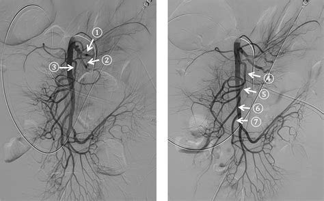 Angiography Of The Computed Tomography Ct Of The Superior Mesenteric