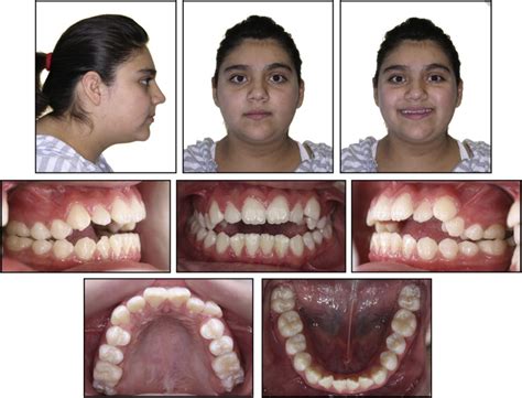 Nonsurgical Approach To Class I Open Bite Malocclusion With Extrusion
