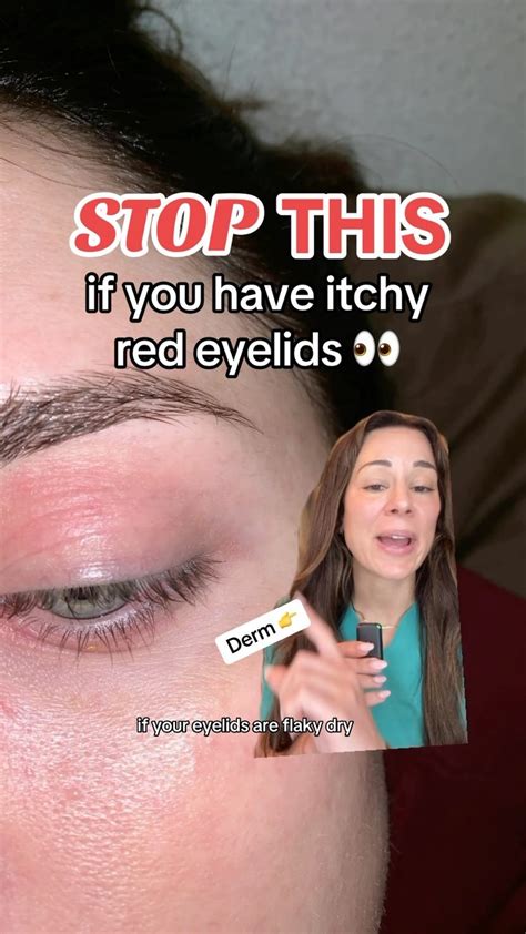 Eyelid Dermatitis Eyelid Dermatitis Xeroderma Of The Eyelids Eczema