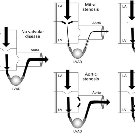 Pdf Implantable Left Ventricular Assist Devices
