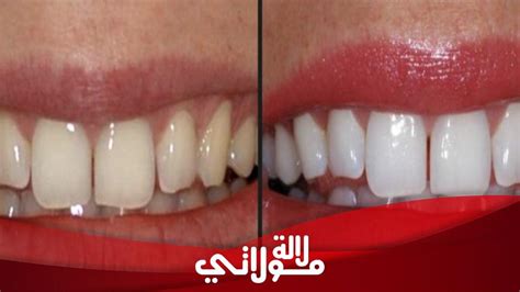 تخلصي من اصفرار الأسنان دون معاناة ودون طبيب والسر في هذه المكونات