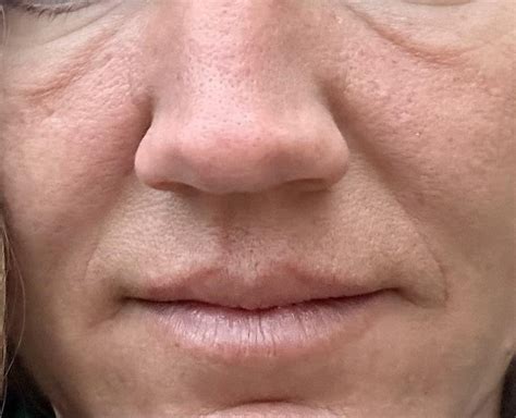 Hyperpigmentation On Perimeter Of Lips Rdermatologyquestions