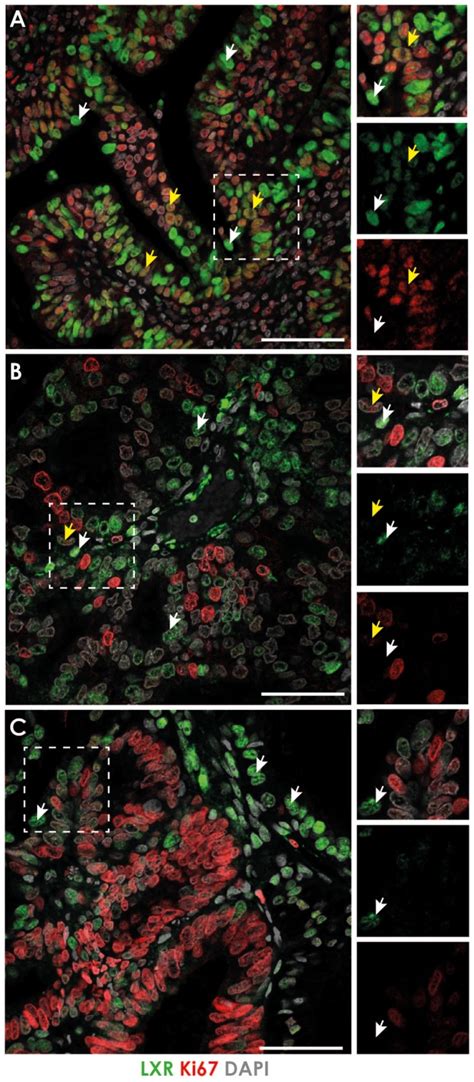 The Impact Of 27 Hydroxycholesterol On Endometrial Cancer Proliferation