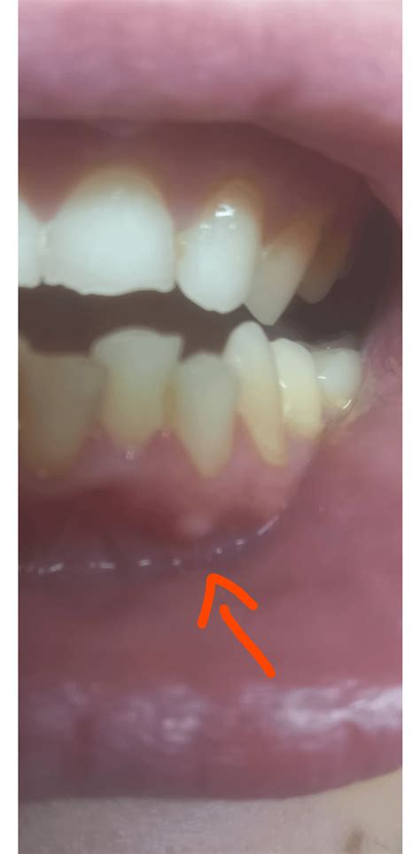 Gumboil Or Bone Exostosis R Askdentists