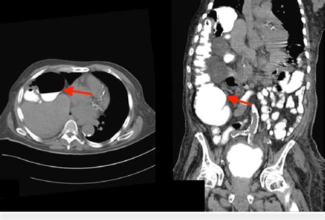 Abdominal Computed Tomography Scan Axial And Coronal Views With