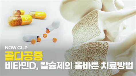 골다공증 비타민d 칼슘제의 올바른 치료방법 Youtube