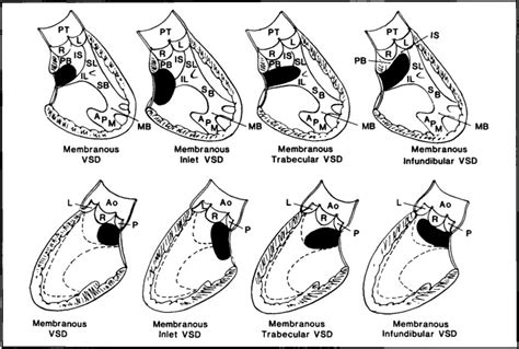 Standardized Nomenclature Of The Ventricular Septum And Ventricular