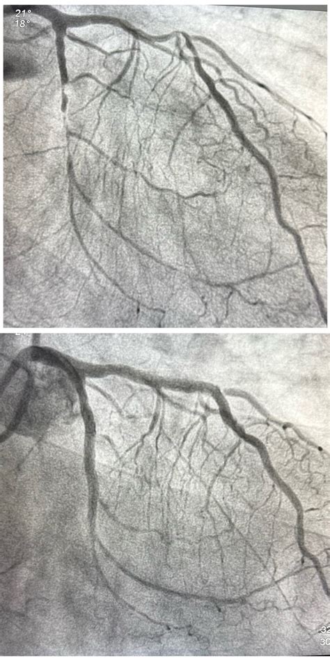 Very Critical Stenosis Of Lad And Lcx Performed Angioplasty At Adilabad For An 86 Years Old