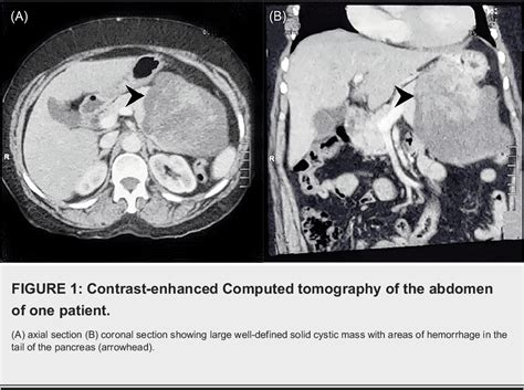 Figure 1 From Solid Pseudopapillary Neoplasm Of The Pancreas A Single