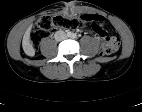 Infected Urachal Cyst In An Adult Emergency Medicine Journal