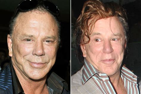 Saving Face Mickey Rourke Shows Off Plastic Surgery Aftermath 9thefix
