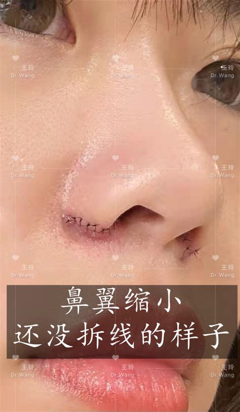 鼻翼缩小还未拆线和术后11个月的真实样子 哔哩哔哩