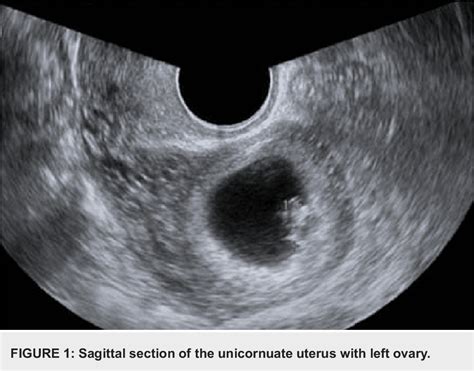 Figure 1 From A Case Report On A Left Unicornuate Uterus With