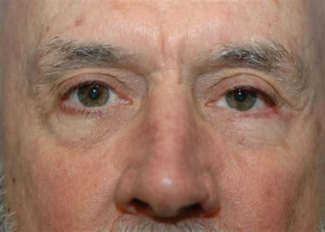 Skin Cancer Reconstruction 17 Amadi Aesthetics Plastic Surgery