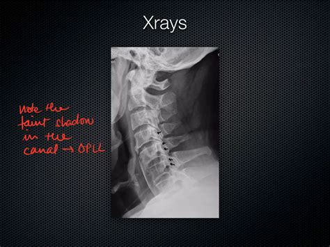 Cervical Spondylotic Myelopathy Ppt