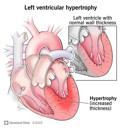 Left Ventricular Hypertrophy Lvh Causes Symptoms And 56 Off