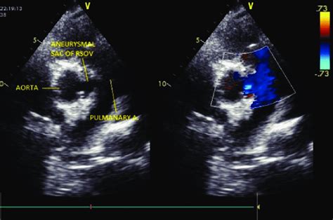 Transthoracic Two Dimensional Echocardiography Showing An Download