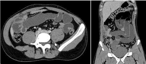 Figure 1 From A Case Report Of Small Bowel Occlusion Due To Meckel