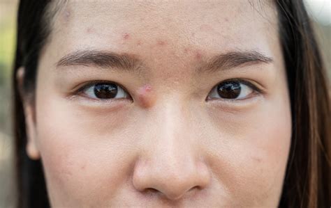 큰 여드름 과 여드름이 그녀의 얼굴에 염증을 가진 추악한 아시아 여성의 자른 샷 낭포에 대한 스톡 사진 및 기타 이미지 Istock