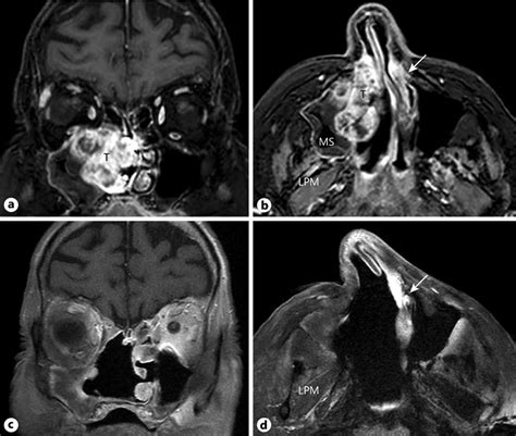 Contrast Enhanced Mr Images Showing A Sinonasal Acc Involving The