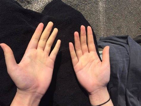 15 Photos That Show What It Looks Like To Live With Raynaud S Syndrome