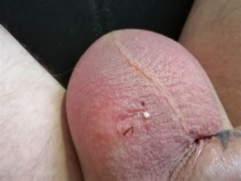 Saline Infusion In Scrotum First Try 1 Liter 25 Pics Xhamster