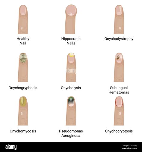 Nail Diseases Vector Illustration Design Stock Vector Image And Art Alamy