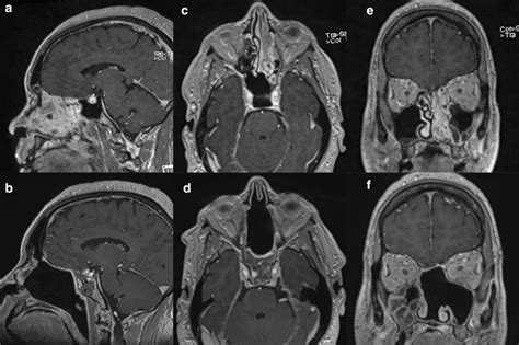 Pre And Post Operative Mri Of The Patient Whose Procedure Is Depicted