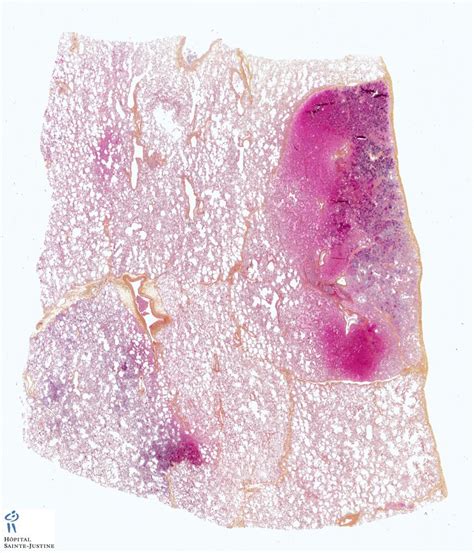 Pulmonary Hemorrhages Human Pathology