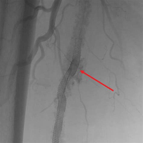 Superficial Femoral Artery Sfa Angiogram Diffuse And Long Segment