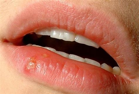 Cold Sore Findatopdoc