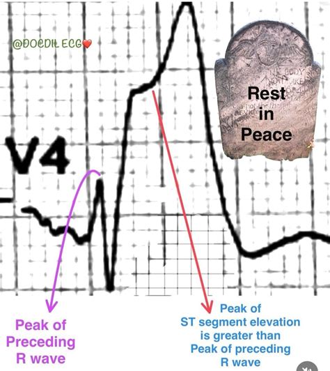 Beware Of The Tombstone Ecg👇 Lisa Lewandowski