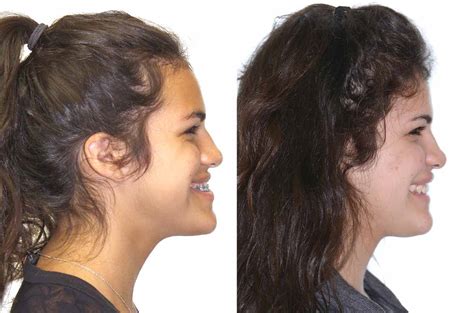 Face Bite And Airway Correction Corrective Jaw Surgery Dr Antipov